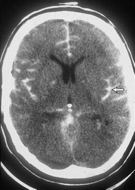 Subarachnoid Hemorrhage Sah Neurologic Disorders Merck Manual