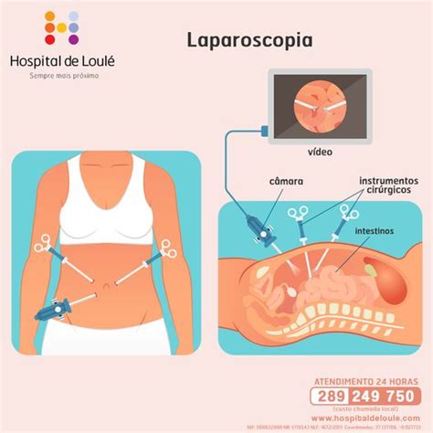 O Que é Uma Laparoscopia Hospital De Loulé