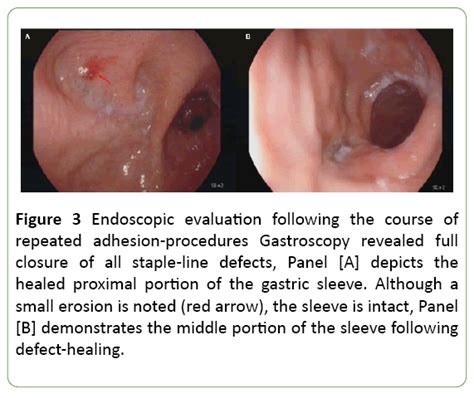 Endoscopic Biological Glue Injection For Treating Multiple Staple Line Leaks And Dehiscence