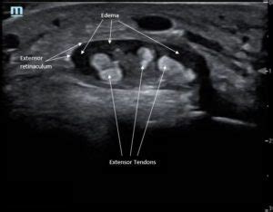 Extensor Tenosynovitis Of The Wrist Axial Image Annotated Jetem 2019