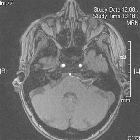 A Left Retrosigmoid Craniotomy With Cranioplasty Was Performed In The Download Scientific