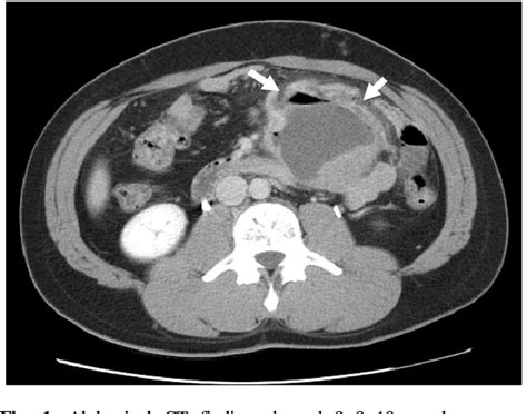 Antibiotics For Abdominal Abscess