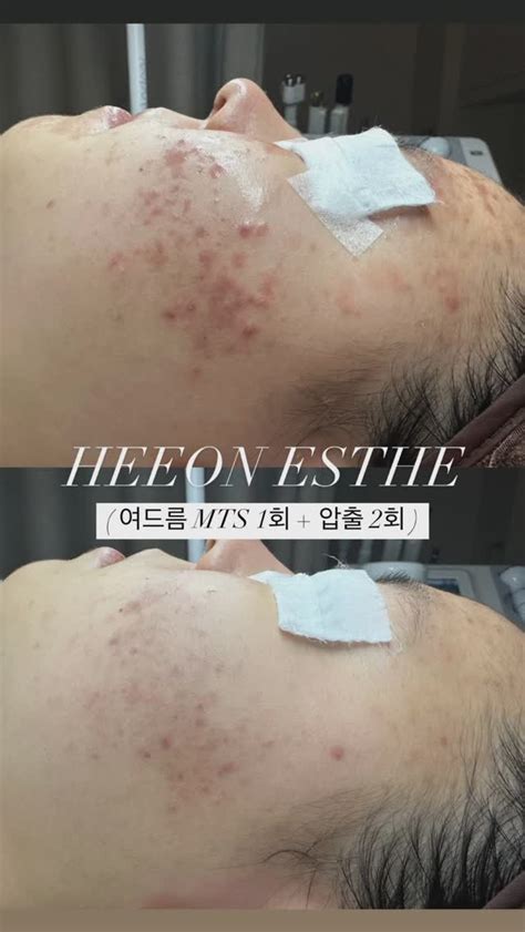 기흥동백피부관리 여드름 문제성피부전문 희온에스떼 대표 이현희 희온에스떼 엑소15698 여드름 자국 색소 흉터