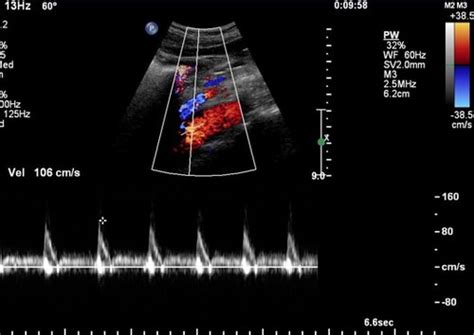 Abdominal Aorta Mesenteric Flashcards Quizlet