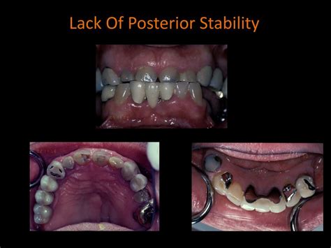 PPT Fundamentals Of Occlusion PowerPoint Presentation Free Download ID 2143561