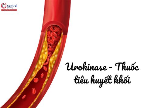 Urokinase Thuốc Tiêu Huyết Khối Dược Thư Quốc Gia 2022