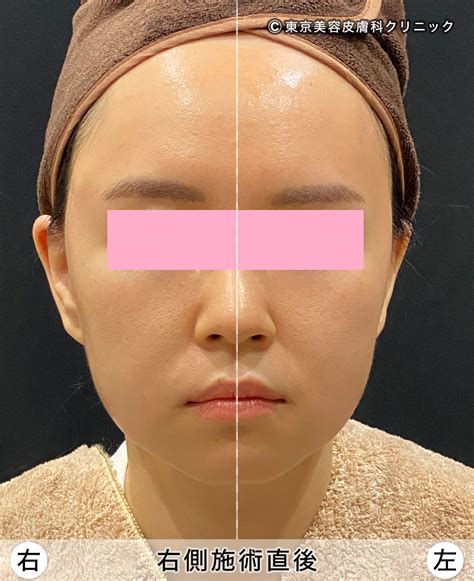 症例写真｜サーマクールflx｜東京美容皮膚科クリニック｜港区浜松町