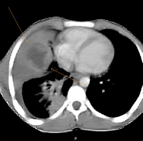 Hydatid Cyst Ct Sumers Radiology Blog