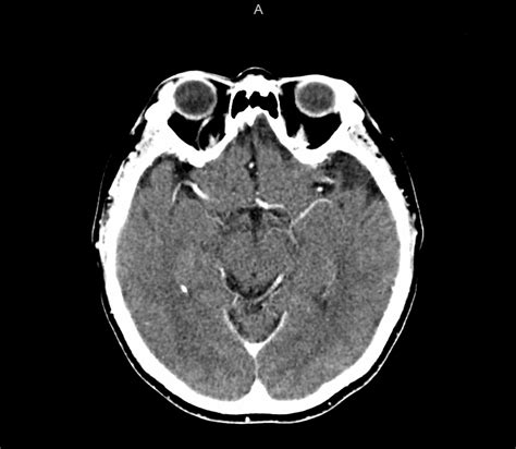 Ophthalmology Dx Double Vision After Collision Ophthalmology Advisor