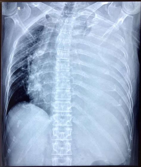 Pleural Effusion Fluid In Pleural Cavity Bhavishya Clinic