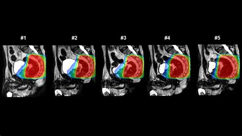 Mr Guided Radiation Therapy For Rectum Products Elekta