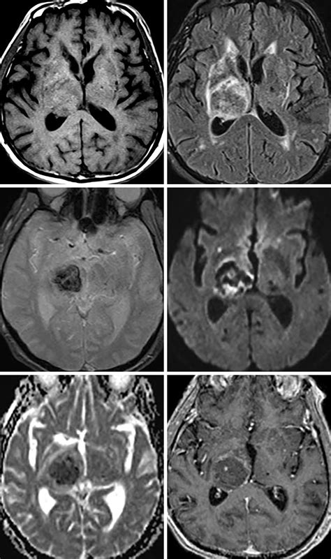 Intracerebral Hemorrhage Mri