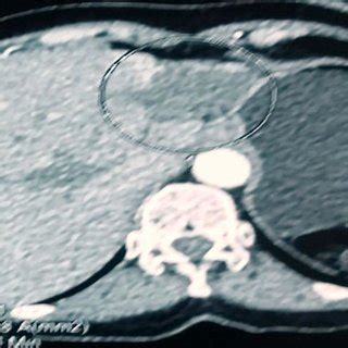 Enhanced CT Of The Abdomen And Pelvis Evoking A GIST Mass Surrounded Download Scientific