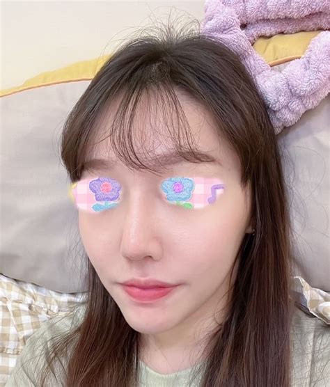 分享 鼻中隔彎曲歪鼻的隆鼻心得分享💕 醫美板 Dcard
