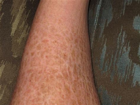 Routine Help Seriously Dry Scaly Looking Shins How To Fix R