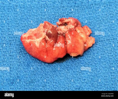 Appendix Removal Surgery Perforated Appendix Removed From A Patient During An Appendectomy