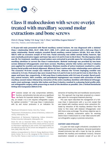 Class Ii Malocclusion With Severe Overjet Treated With Maxillary Second Molar Extractions And