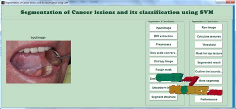 Texture Analysis Based Segmentation And Classification Of Oral Cancer Lesions In Color Images