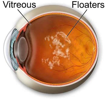 Floaters — Niall Patton Consultant Ophthalmologist Cataract And