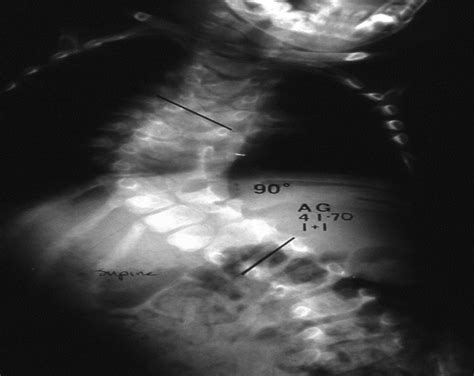 Congenital Thoracic Scoliosis With Unilateral Unsegmented Ba Spine