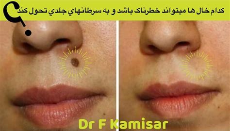 کدام خال های خدایی مبدل کلینیک تخصصی جلدی و زیبائی تاج
