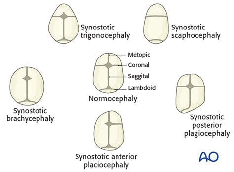 Bilateral Lambdoid Synostosis