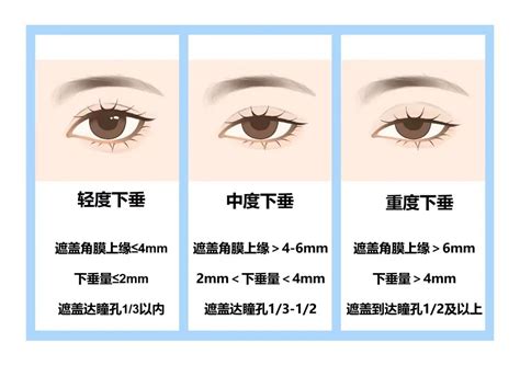 上睑下垂 专科科普