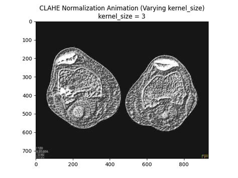 Ct Scan Pre Processing To Enhance Paa Segmentation Accuracy