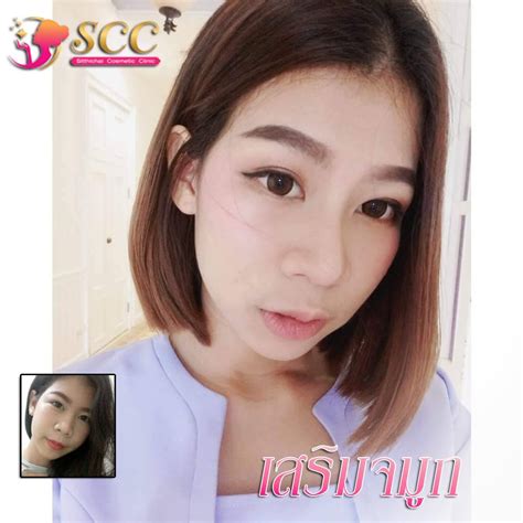 เสริมจมูกโปรโมชั่นสุดพิเศษจาก Scc Clinic ในราคาเพียง 8 900 ทุกเคสปรึกษาพร้อมทำโดยนายแพทย์สิทธิ
