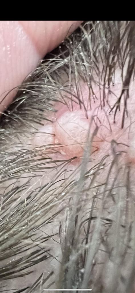 Any Idea What This Is Only On Scalp R Dermatologyquestions