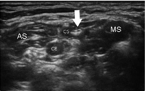 Ultrasound Image Depicting Anatomy Of Dorsal Scapular Nerve Indicated