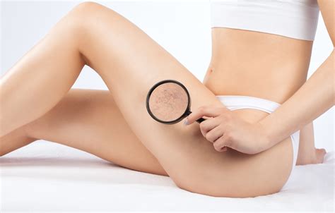 Capillariesspider Veins Removal Eyebrow Ink Styling