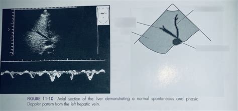 11 10 Transverse Liver Demonstrating Normal Spontaneous And Phasic