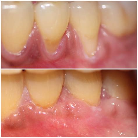 Gallery Root Coverage Recession Uptown Guelph Dental