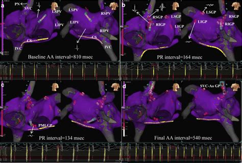 Procedural Steps Of Cardioneuroablation On Electroanatomical Mapping Download Scientific