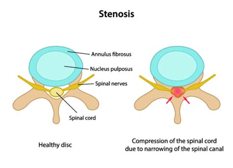 Living With Cervical Spinal Stenosis My Story Regenexx