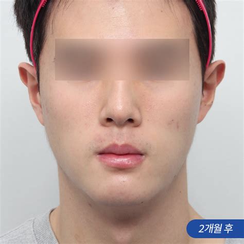 턱끝전진 2개월 후 미드라인성형외과