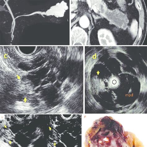Branch Duct Bd Type Ipmn Noninvasive Carcinoma Hyperechoic Mass