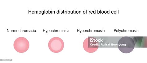 적혈구 형태학 적혈구의 헤모글로빈 분포 Thalassemia에 대한 스톡 벡터 아트 및 기타 이미지 Thalassemia