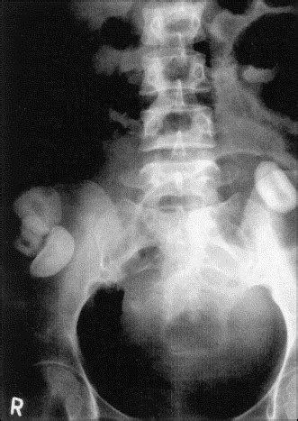 Crohns Disease Presenting As Enterolithic Intestinal Obstruction The