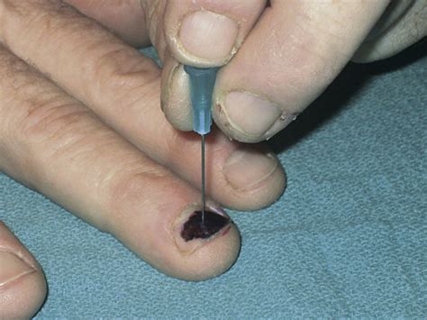 Subungual Hematoma Management Sports Medicine Review