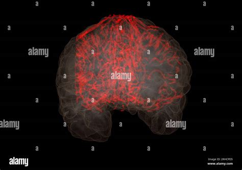 Cerebral Blood Vessels Mri Angiogram Scan Stock Photo Alamy
