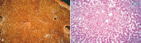 Hemodynamic Disorders Thromboembolic Disease And Shock Flashcards
