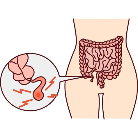 Best Appendicitis Treatment In Bangalore Hari Laser Clinic