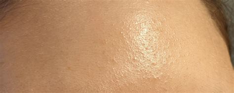 How To Get Rid Of These Small Bumps On Forehead R30plusskincare