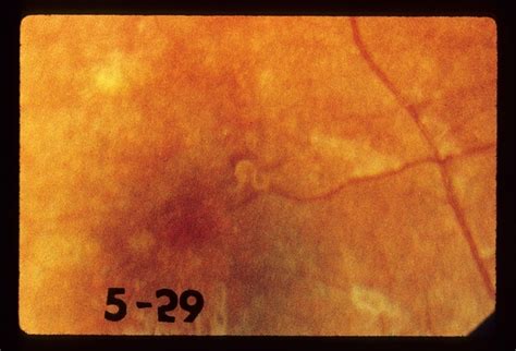 Toxocara Canis Retina Image Bank