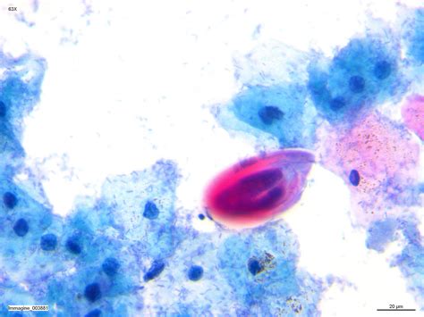 Pathology Outlines Enterobius Vermicularis