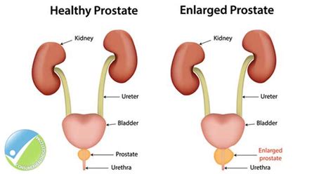 Prostate Enlargement Symptoms Causes And Treatment