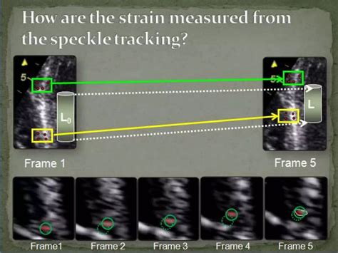Speckle Tracking Echocardiography Ppt