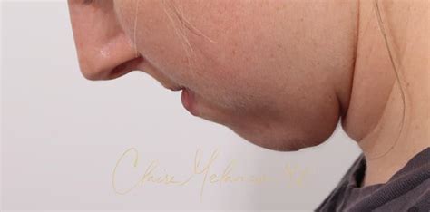 Chin Implant Before And After 03 Audubon